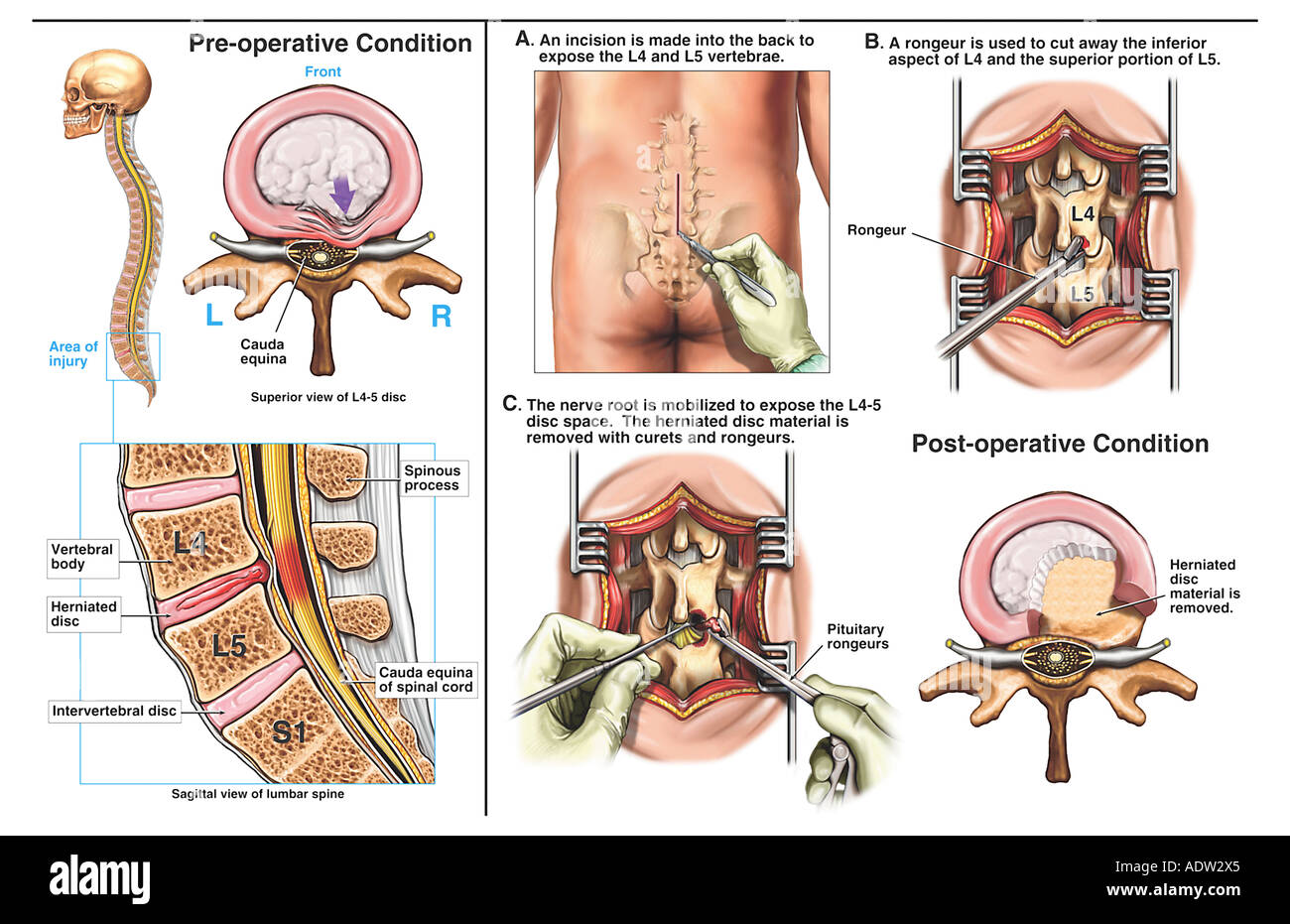 Spine Surgery L4 5 Disc Herniation With Discectomy Diskectomy Stock