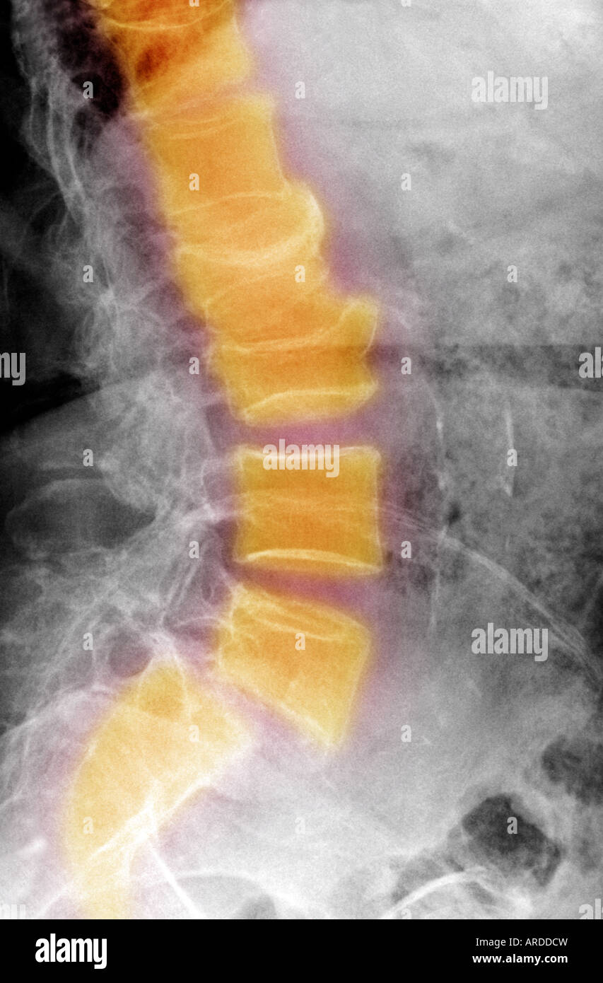 Lumbar Spine Xray Showing A Grade II Anterolisthesis Of L5 On S1 Stock Lumbar Spine Xray Showing A Grade II Anterolisthesis Of L5 On S1 Stock