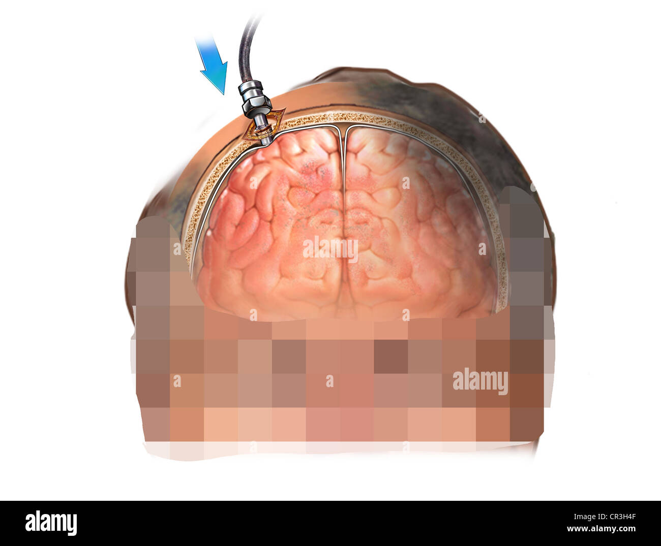 Insertion of Intracranial Pressure Monitor (ICP) Bolt Stock Photo ... Insertion of Intracranial Pressure Monitor (ICP) Bolt Stock Photo ...