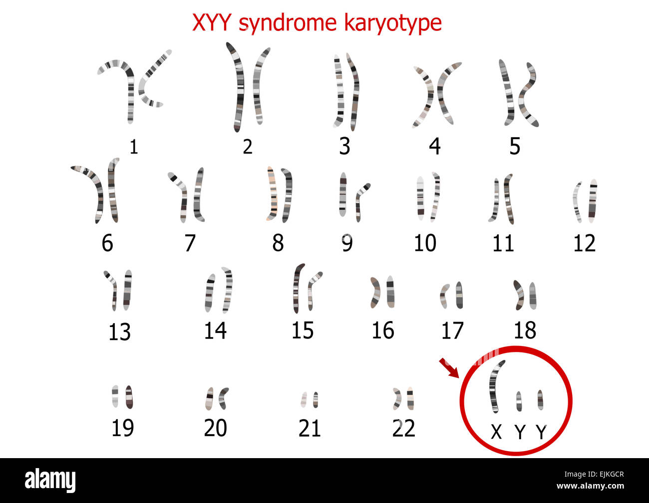 XYY Syndrome supermale Karyotype Stock Photo 80335271 Alamy XYY Syndrome supermale Karyotype Stock Photo 80335271 Alamy
