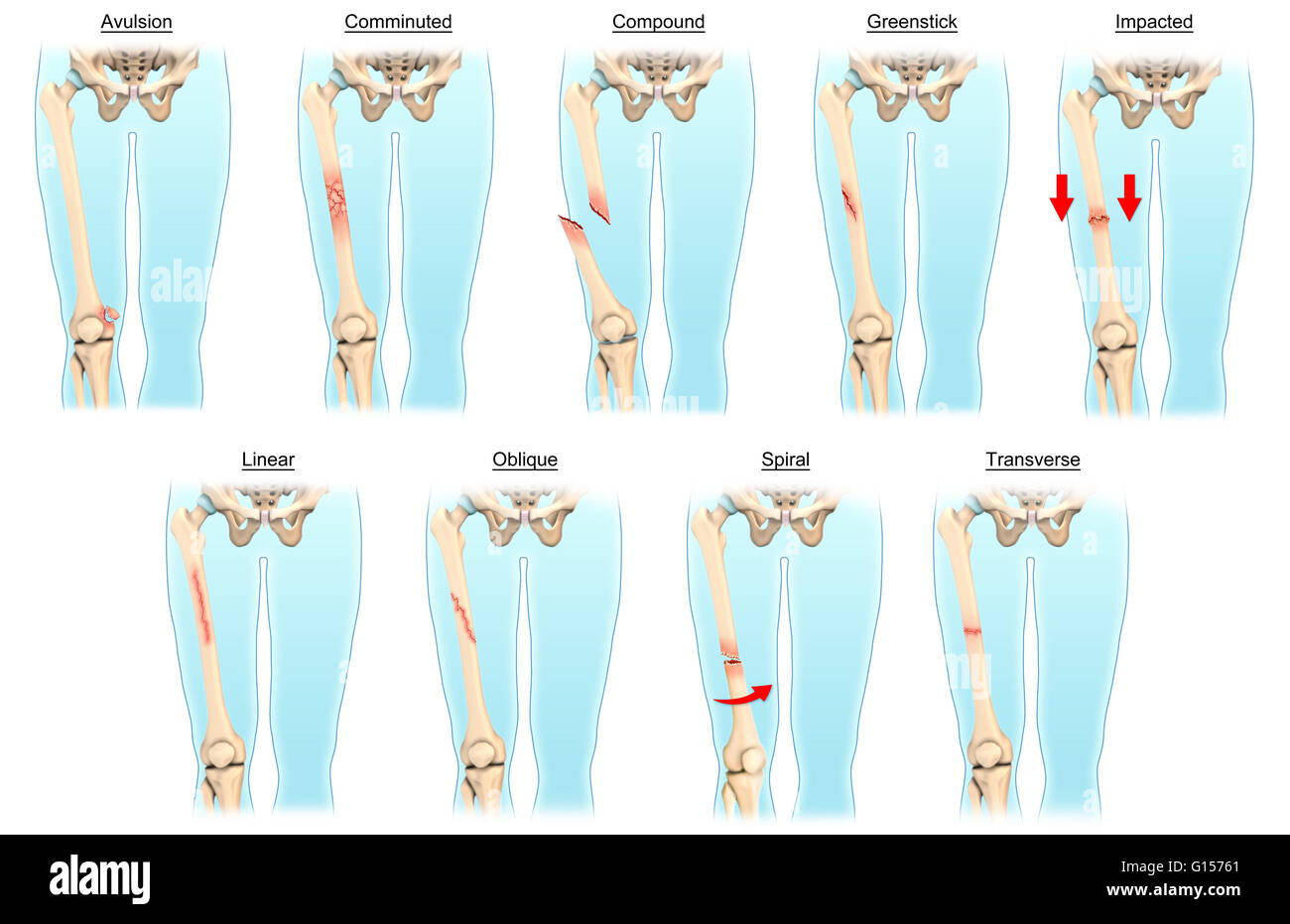 An illustrated diagram depicting various types of fractures depicted An illustrated diagram depicting various types of fractures depicted