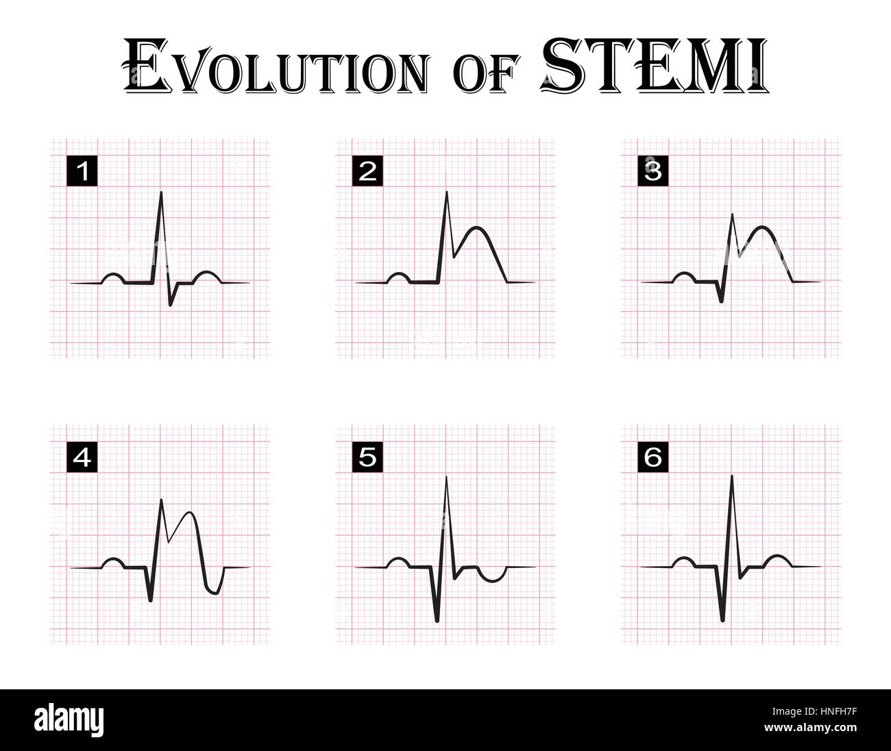 St Elevations Monitoring For Infarction Stemi Electrocardiogram Ecg Ekg