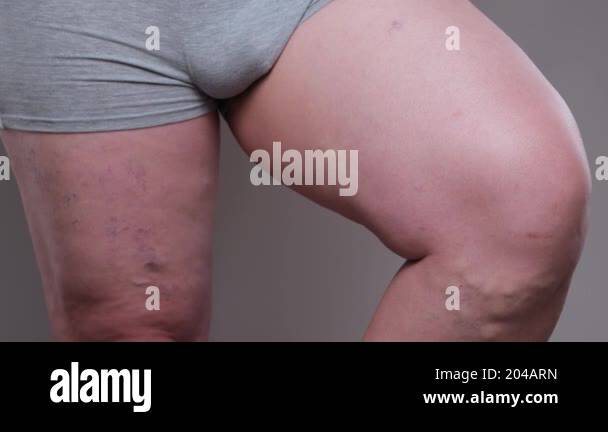 Removal of varicose veins on the legs. Medical inspection and treatment ...