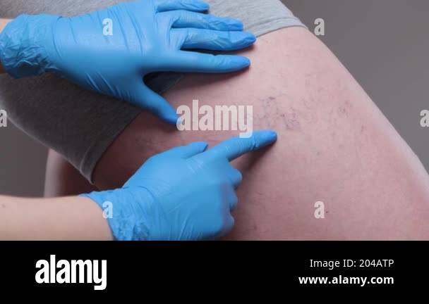 Removal of varicose veins on the legs. Medical inspection and treatment ...
