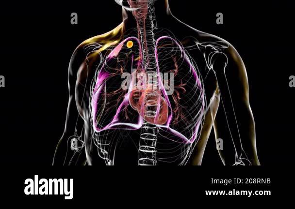 3D animation of a transparent human body showing apical tuberculosis in ...