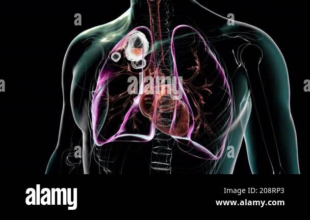 3D animation of a transparent human body showing cavitary tuberculosis ...