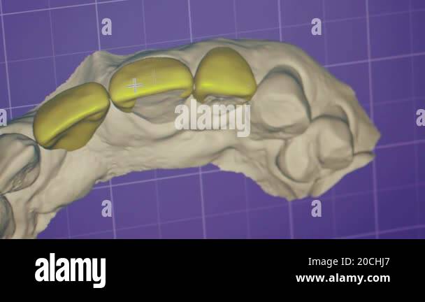 3D modeling teeth showing on computer dental implant equipment medical ...