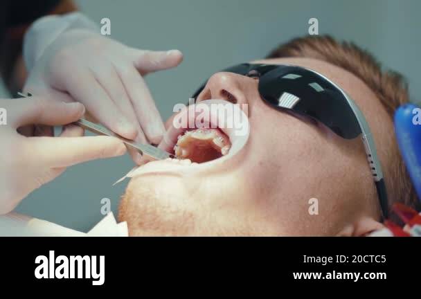 Young face man mouth, dentist with special tools puts braces. Reception ...