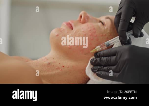 Cosmetologist performing biorevitalization injections with a syringe ...