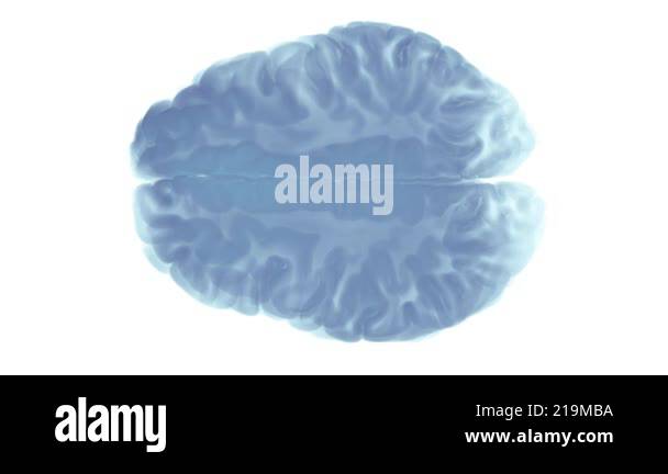 MRI of the brain highlighting an ischemic stroke in the left frontal ...