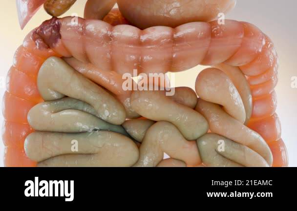 Colorectal cancer, malignant tumor in intestine, Endoscope inside ...