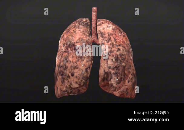 3D illustration of lungs showing severe COPD damage, highlighting ...