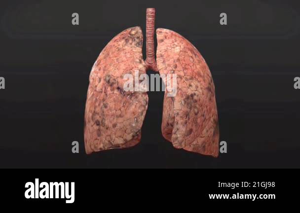 3D model of lungs with moderate COPD, displaying airway narrowing and ...