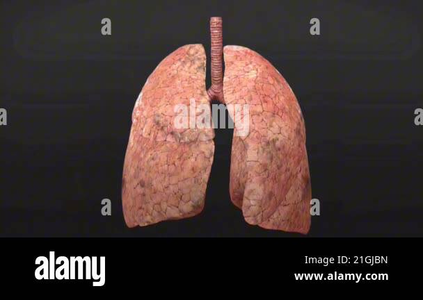 3D illustration of lungs with mild COPD, showing early signs of airway ...