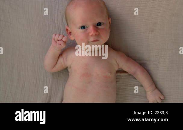 A newborn baby with visible rashes on his body, highlighting a common ...