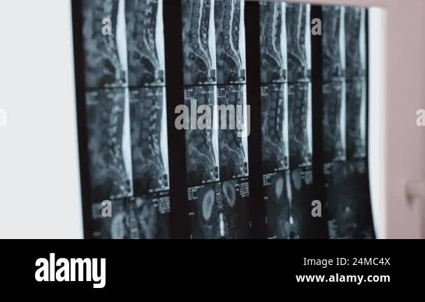 spine X-ray, vertebrae alignment, medical diagnosis. Detailed view of ...