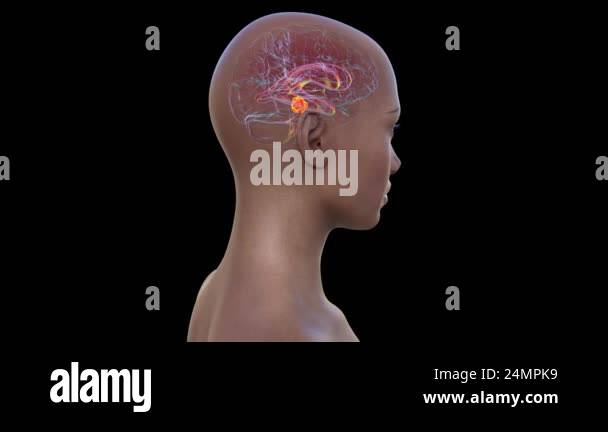 Animation depicting enlarged lateral and third ventricles of the brain ...