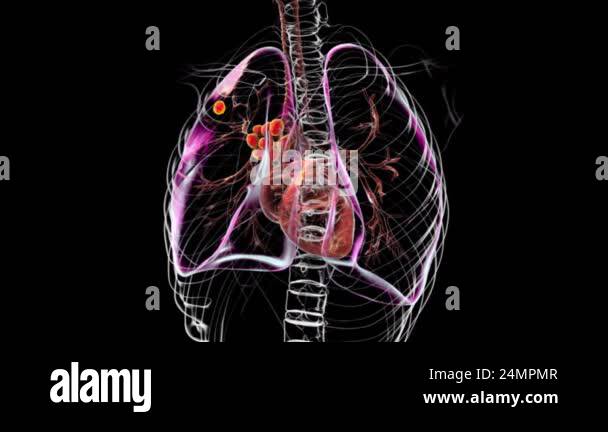 Animation of primary lung tuberculosis, featuring the Ghon complex ...