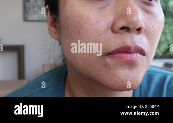Close Up Asian woman face with acne inflamed on her face. haggard face ...