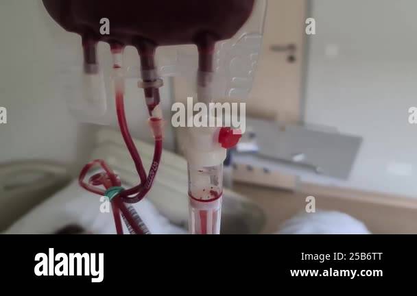Blood bag during transfusion with blood dripping through tube. Patient ...