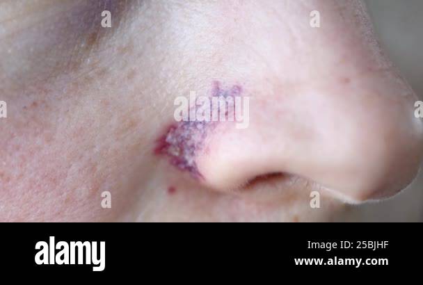 This image shows a closeup of a skin condition on the nose ...