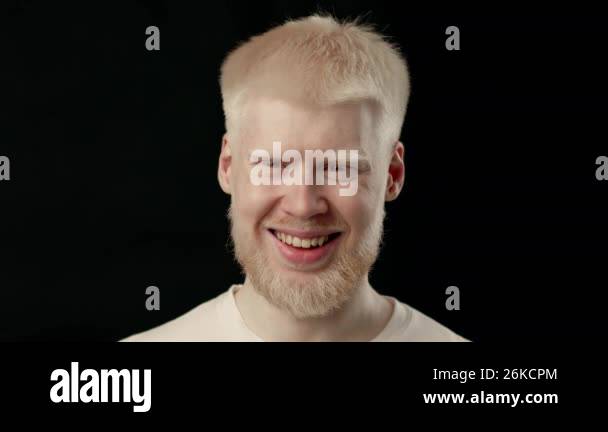 A young man with albinism sits against a dark backdrop, showcasing his ...