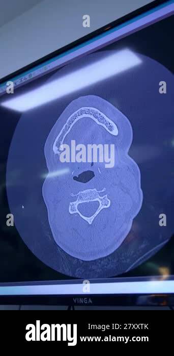 Large monitor with head scan of the patient. Equipment in the modern ...