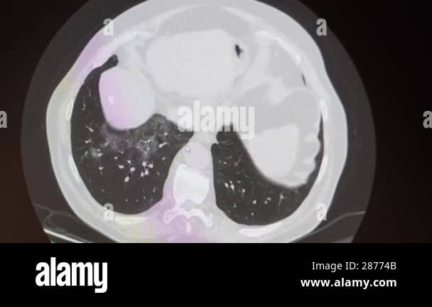 CT scan of the chest showing lung anatomy and internal structures ...