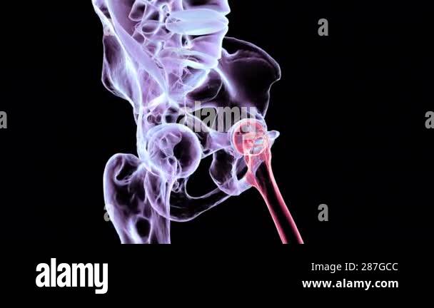 3D animation of human hip bones showing Legg-Calve-Perthes disease, a ...