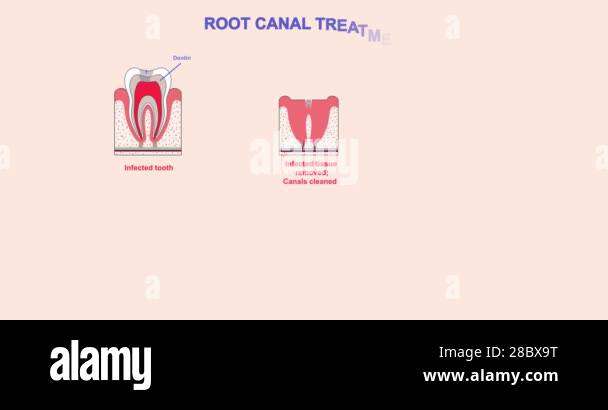 Root canal treatment. Moving banner with medical infographics and ...