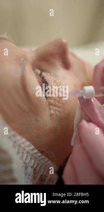 A detailed close-up of a professional performing a cosmetic injection ...