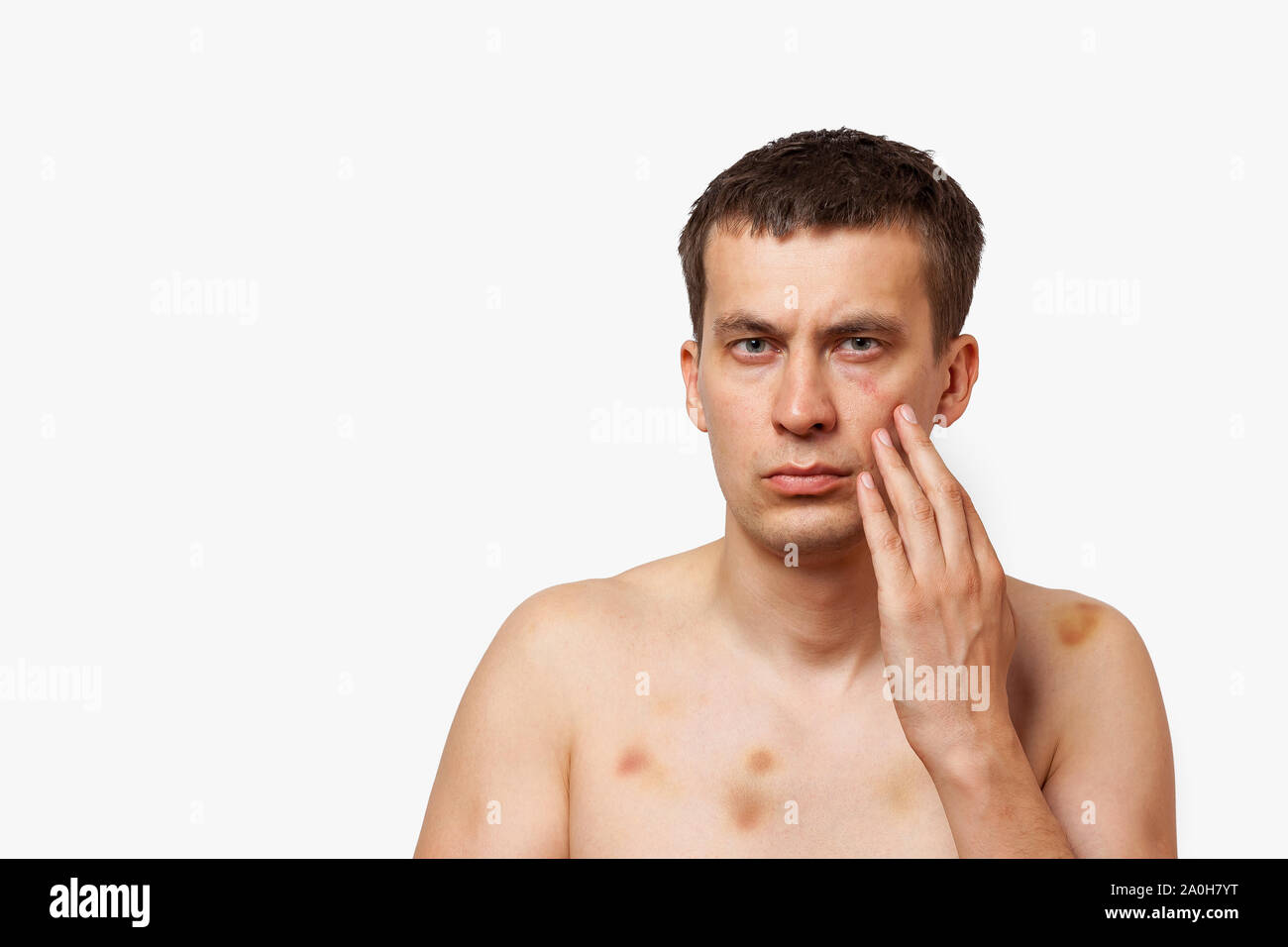 Brunette man with bruises on his body holds his hand to his head in ...