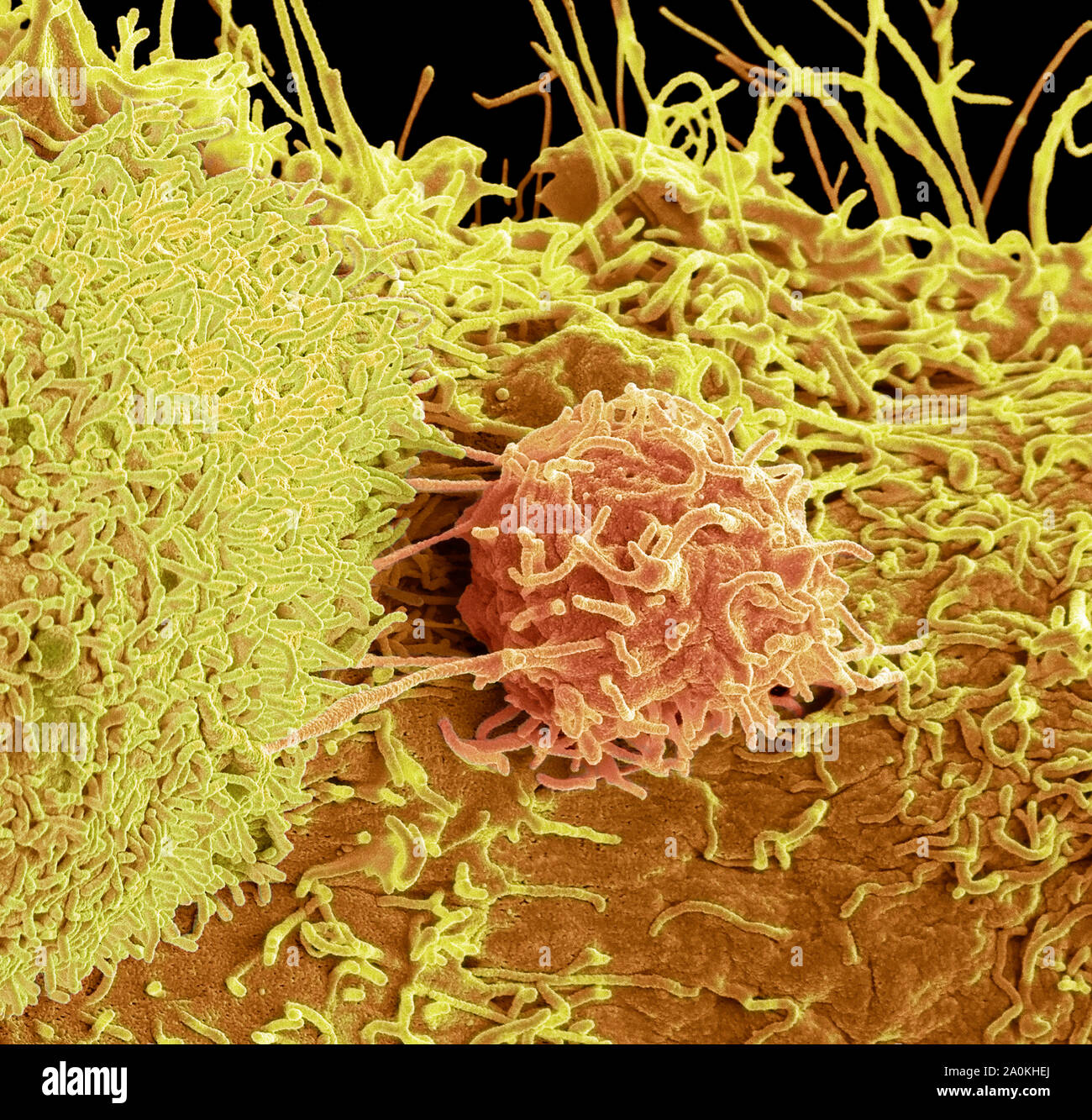 Human prostate cancer cells sem hi-res stock photography and images - Alamy