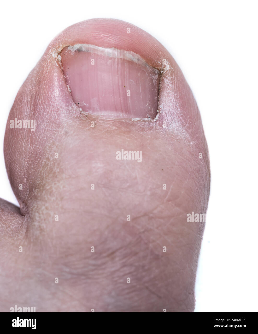 Ugly, Dirty, Weird Big Toe. Close up on white background Stock Photo ...