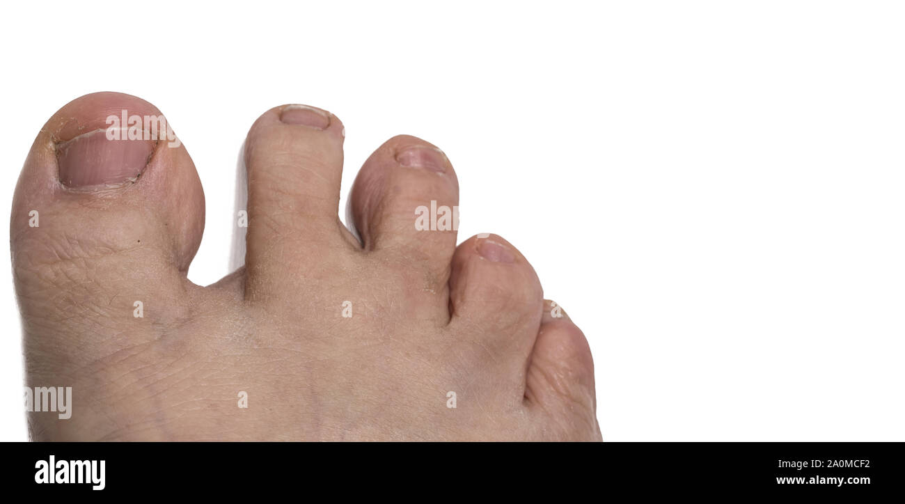 Ugly, Dirty, Weird toes. Close up on white background Stock Photo - Alamy