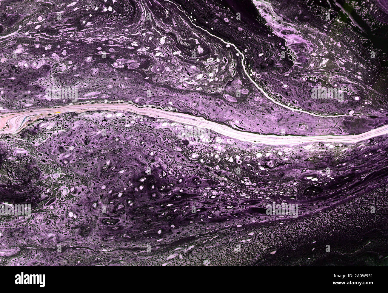 Caseous pneumonia, light micrograph, photo under microscope ...