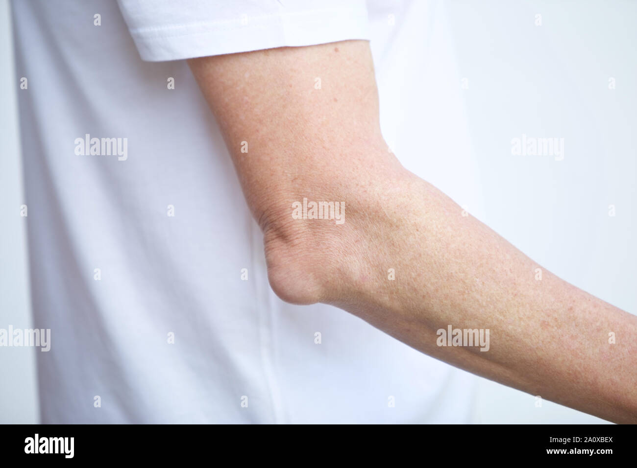 Swelling associated with Bursitis of the elbow Stock Photo - Alamy