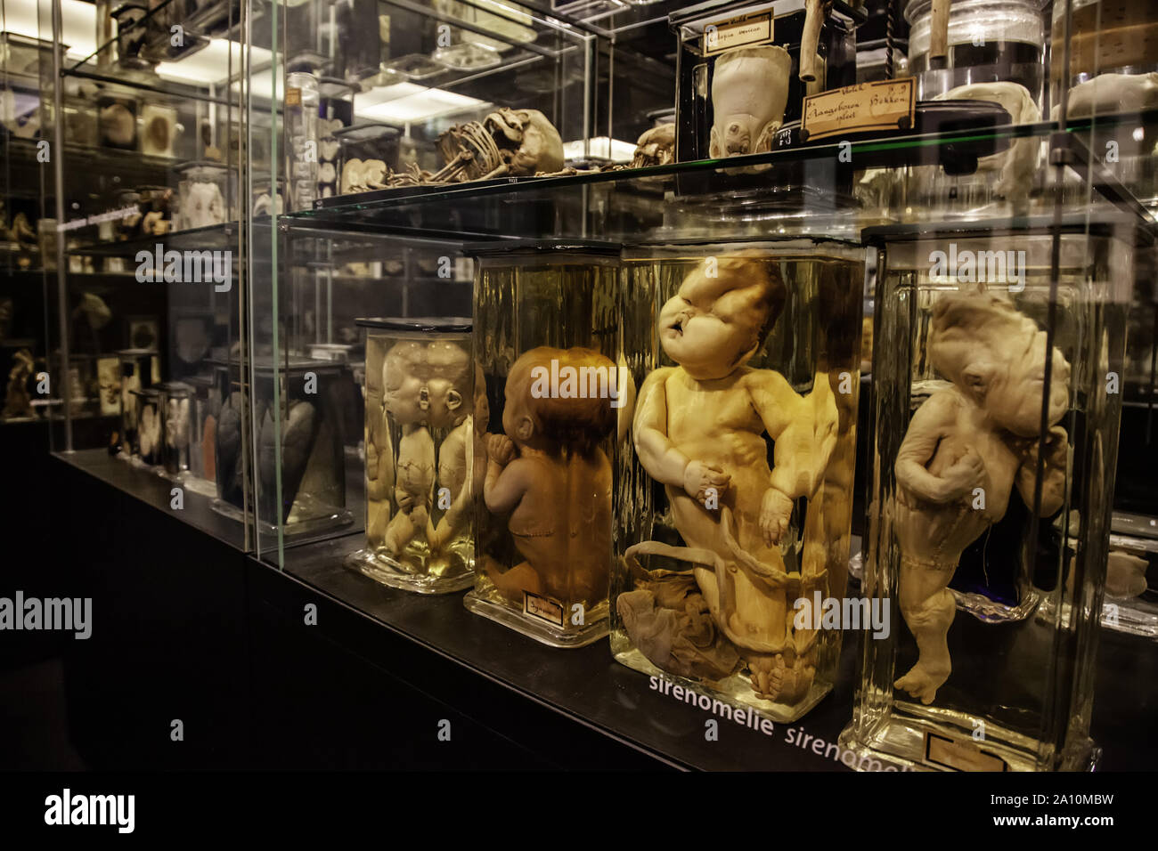 Deformed formalin fetuses in laboratory, clinical genetics, hospital ...