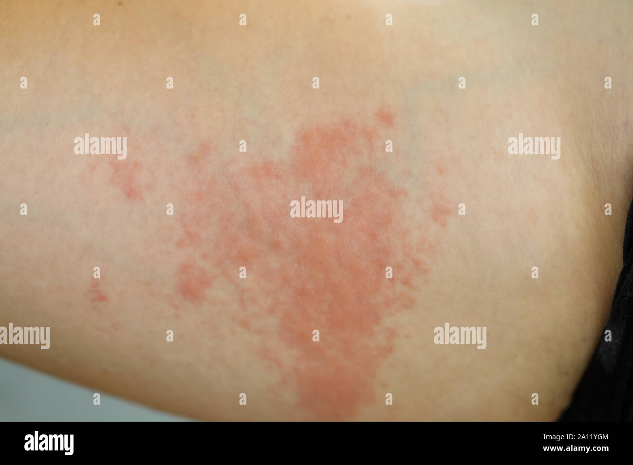Allergic rush on skin Stock Photo - Alamy