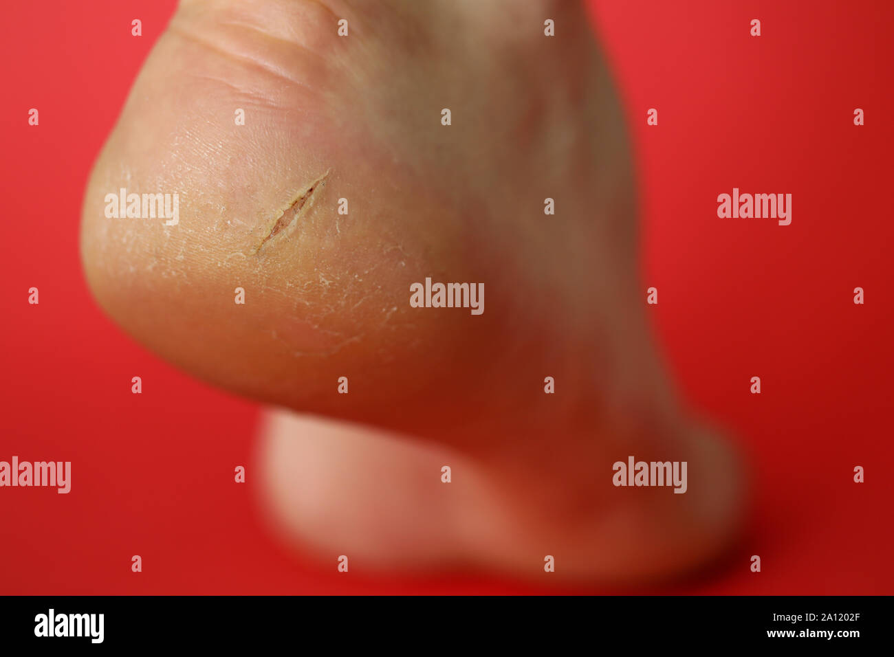 Foot with bad skin Stock Photo - Alamy