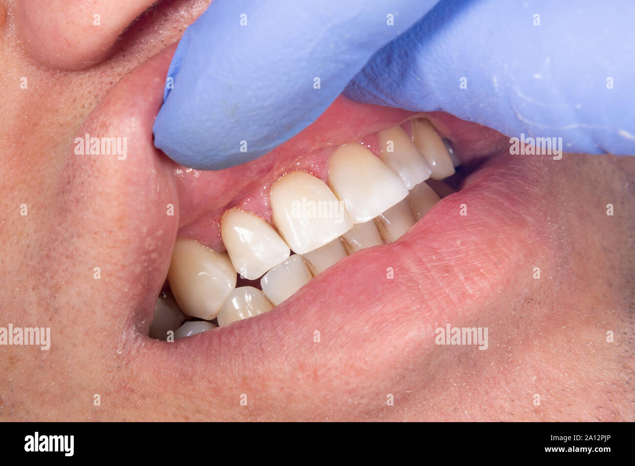 human tooth decay close-up at dentist's appointment. Poor oral hygiene ...