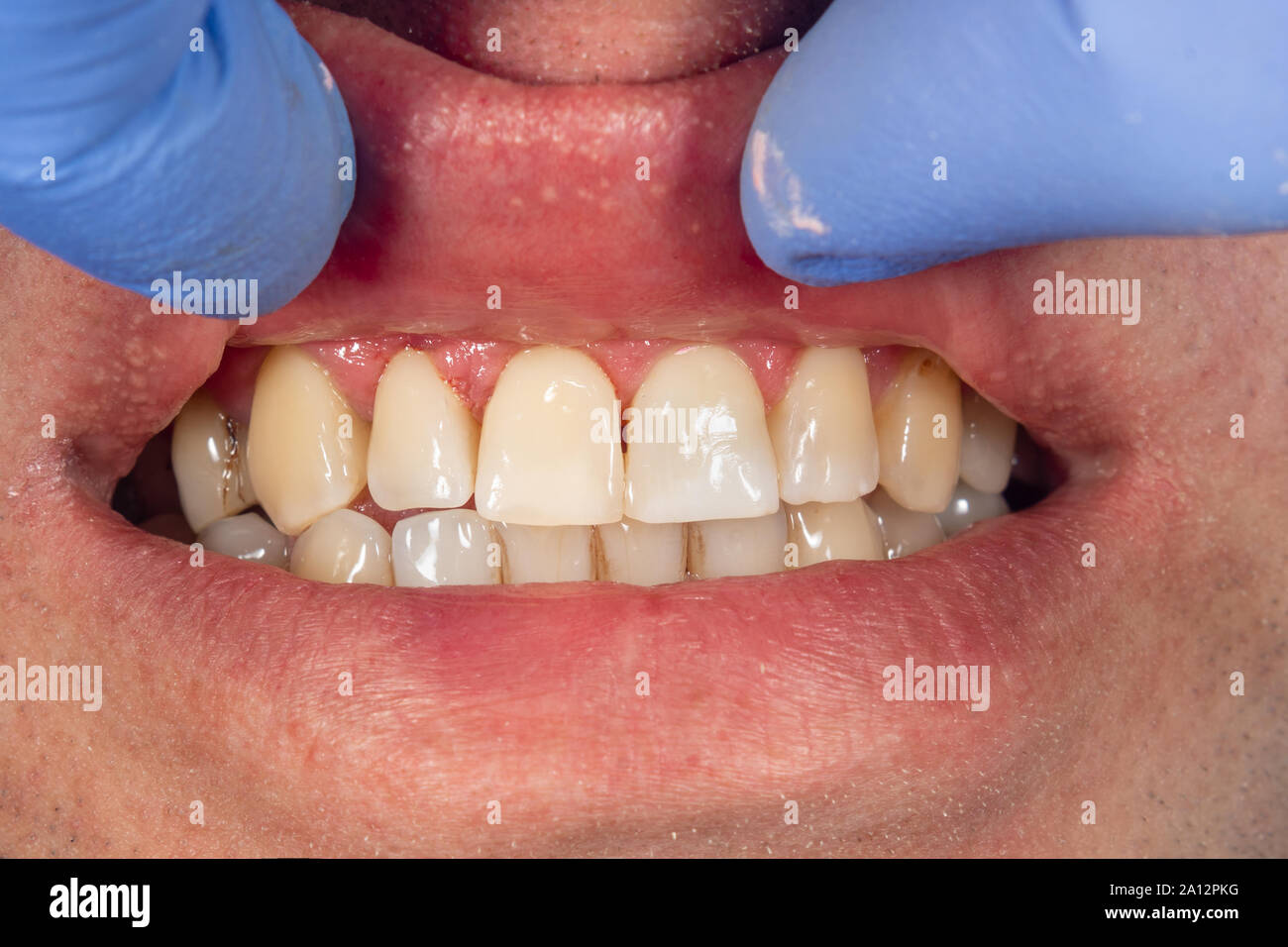 filling of human teeth, close-up. Treatment with polymer fillings at ...