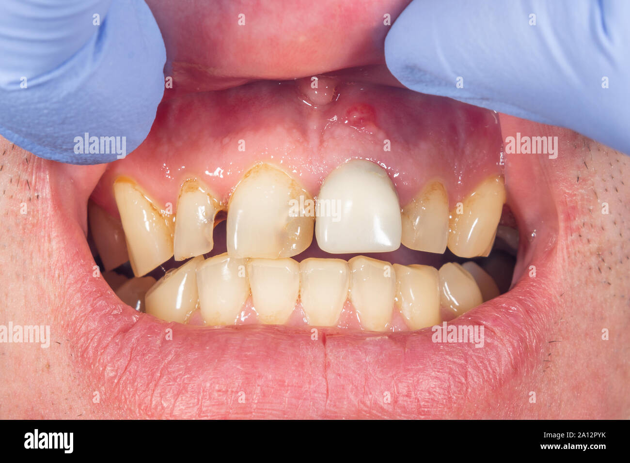 human tooth decay close-up at dentist's appointment. Poor oral hygiene ...