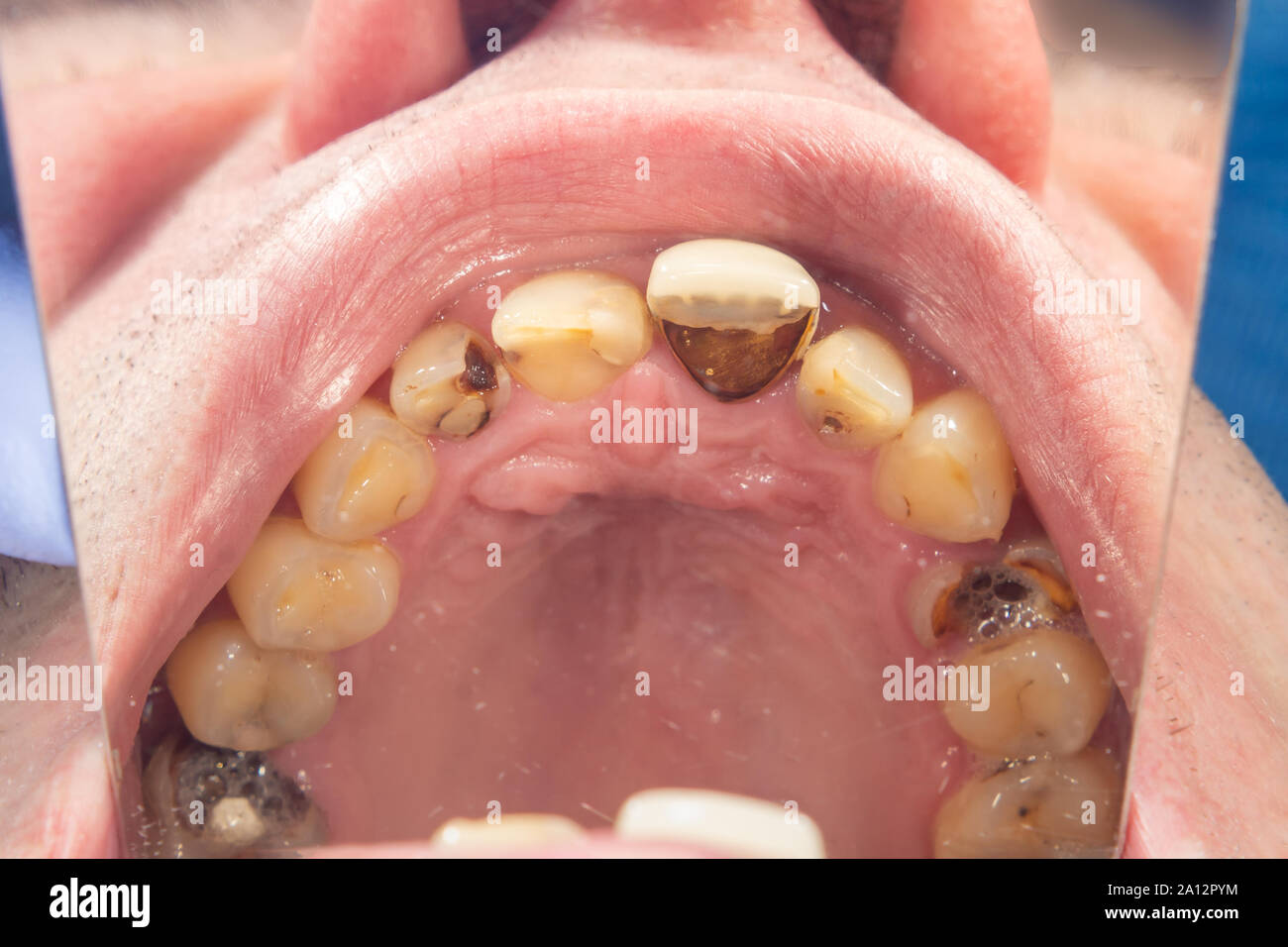 Tooth decay prevention hi-res stock photography and images - Alamy
