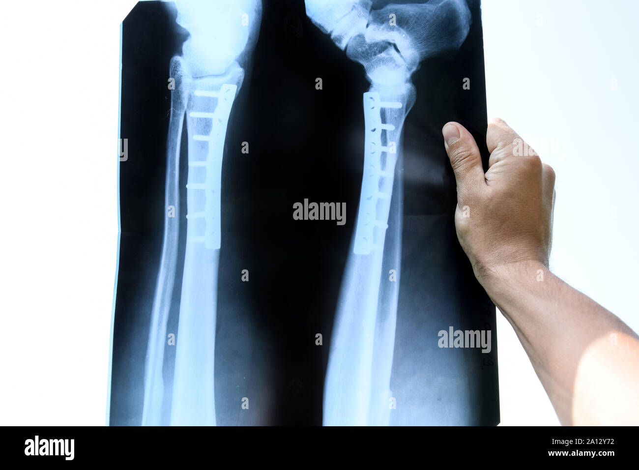 x-ray of the leg. A steel plate holding together the tibia of the leg ...