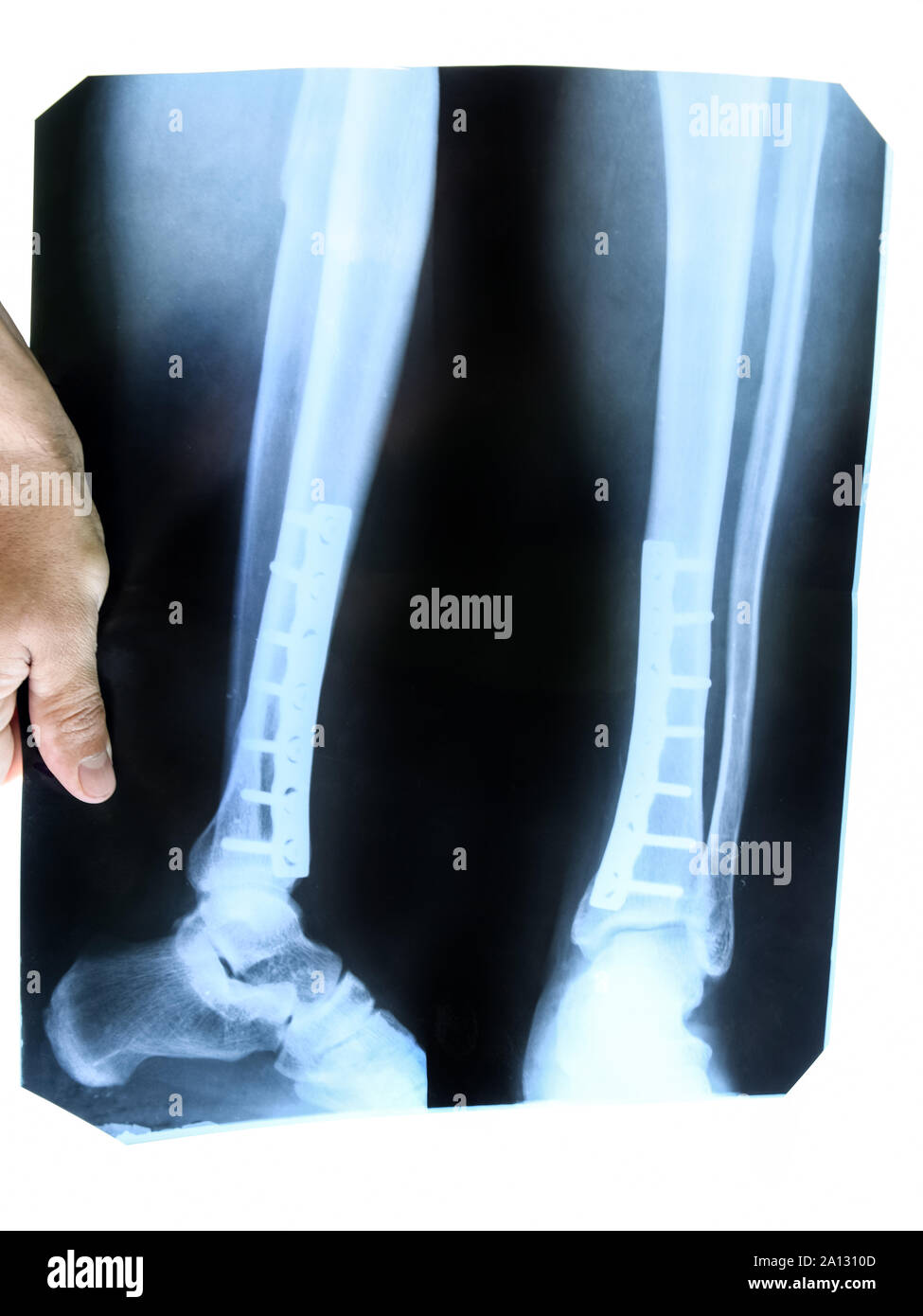 x-ray of the leg. A steel plate holding together the tibia of the leg ...
