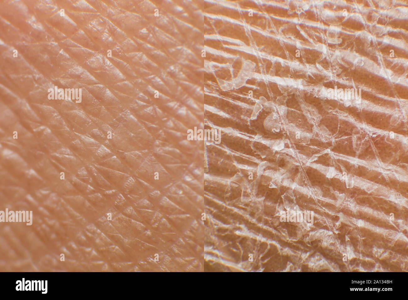 healthy skin and skin covered with Large plaque parapsoriasis on ...