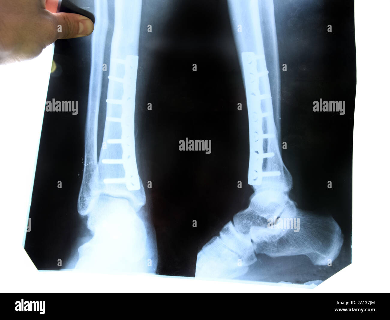x-ray of the leg. A steel plate holding together the tibia of the leg ...