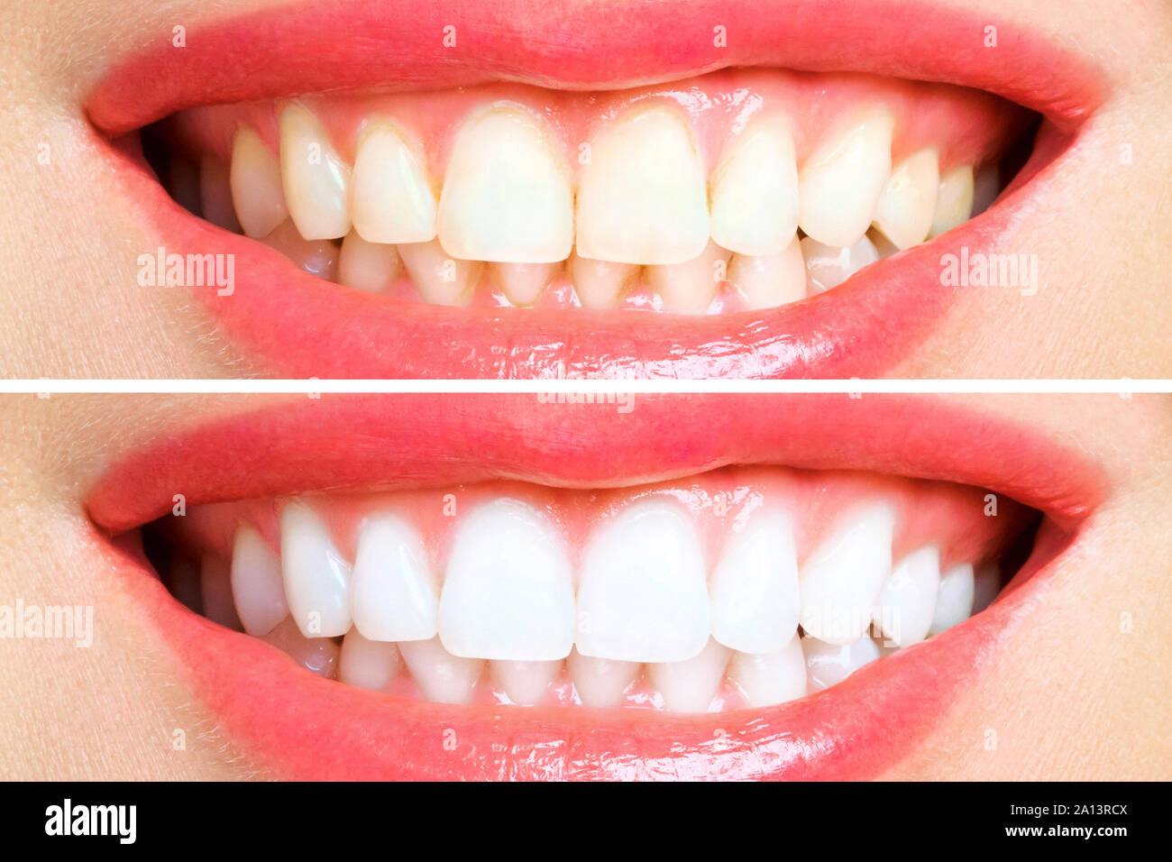 woman teeth before and after whitening. Over white background Stock ...