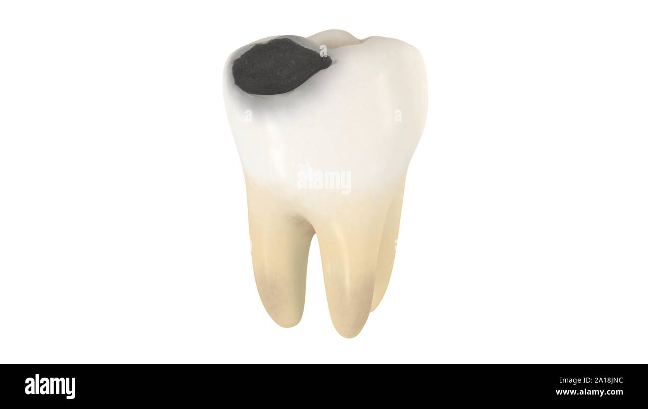 Decay teeth drawing hi-res stock photography and images - Alamy